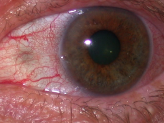 Corneal Foreign Bodies - Warwar Eye Group