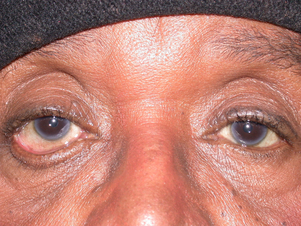 Eyelid Plastic and Reconstructive Surgery - Warwar Eye Group