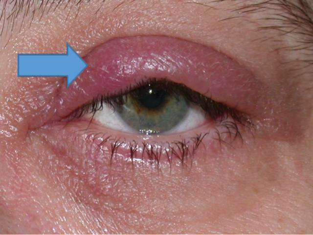 Eyelid Infections - Warwar Eye Group