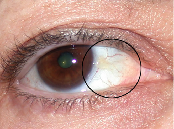 Pinguecula Warwar Eye Group
